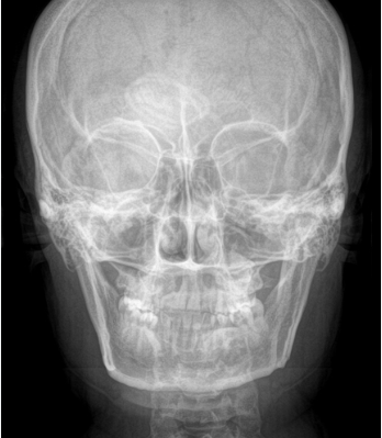 RX ANTEROPOSTERIOR y POSTEROANTERIOR